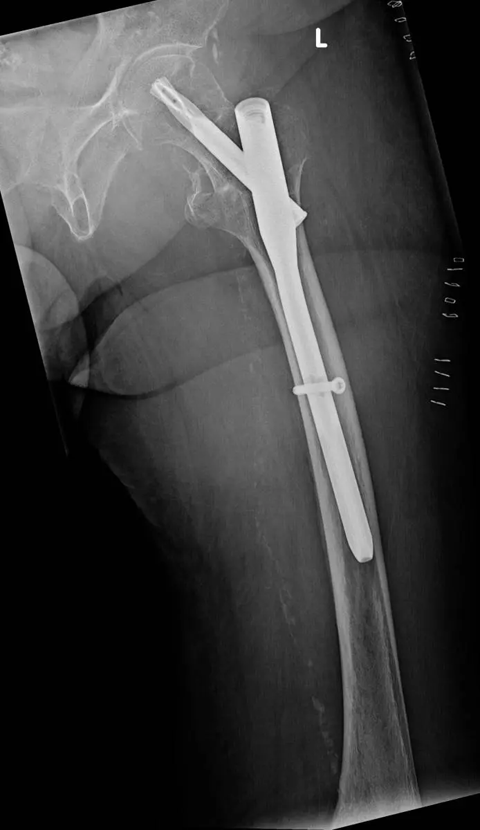 Medical Intramedullary IM Nails Inspection & Measurement